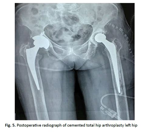 Total Hip Arthroplasty In A Case Of Ochronotic Hip Arthropathy A Case