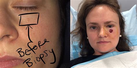 Skin Cancer On Face Looks Like Pimple
