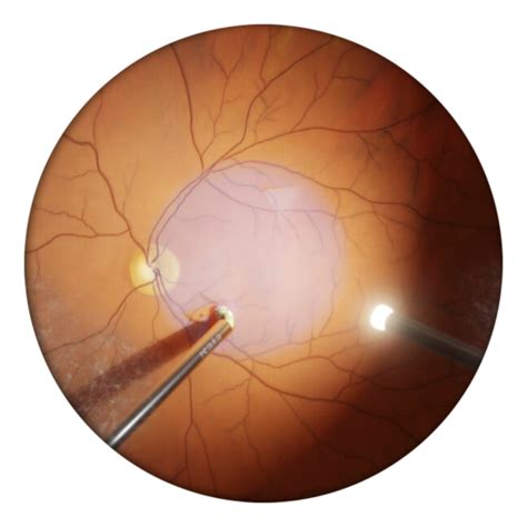 Eyesi Surgical Retina Surgery