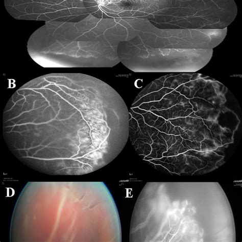 Color Fundus And Fa Photos Of Group 4 Eyes A Fluorescein Angiography