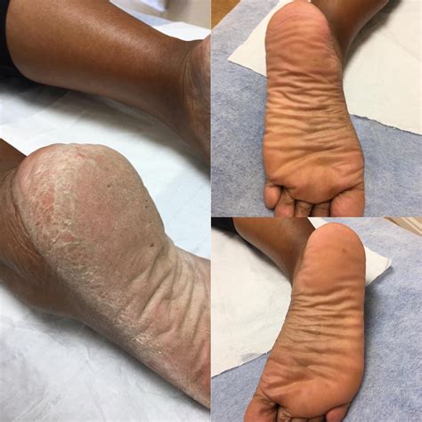 Foot And Callus Peel At Mary Sims Blog