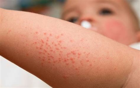 22 روش پیشگیری و درمان عرق سوز شدن در فصل تابستان • دیجی‌کالا مگ