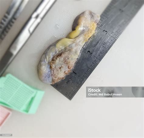 Gallbladder Carcinoma Abnormal Growth Of Tissue Medical Anatomy