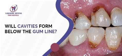 Small Cavities In Teeth Staining Or Cavities On The Front Teeth