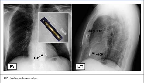 Figure 1 From The Leadless Cardiac Pacemaker Conductive Communication