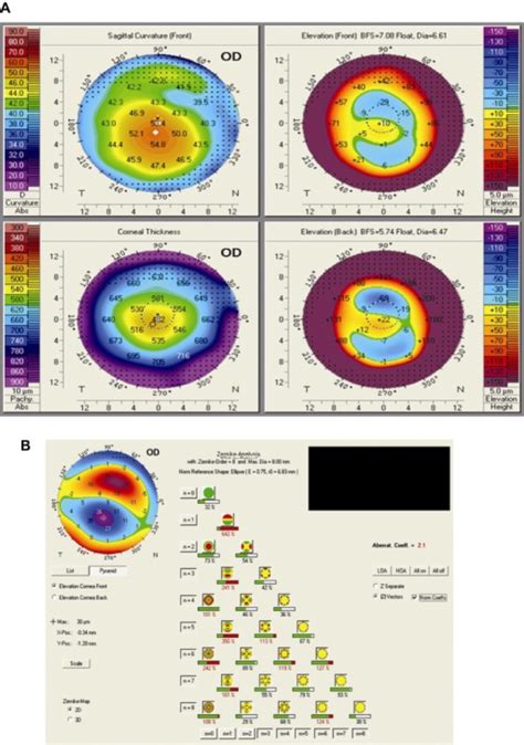 Corneal Topography And Wavefront Aberration Measurement Open I