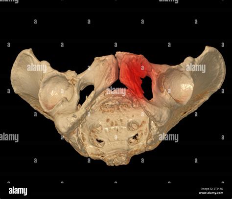 Ct Anatomy Of Pelvic Bones At Angela Link Blog