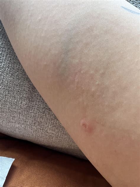 Not Sure If This Is A Bug Bite R Bugbites