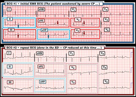 What Does A Final Diagnosis Of Stemi Vs Nstemi Depend Upon Dr