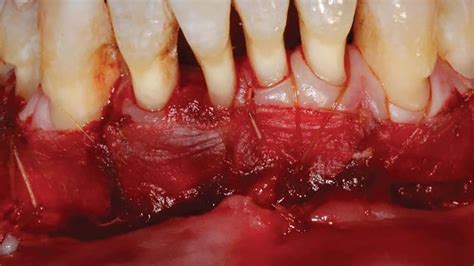 A Case Report On Effective Treatment For A Mucogingival Defect
