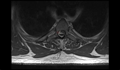 Spinal Epidural Hematoma Mri Radiology Article On Spinal Epidural