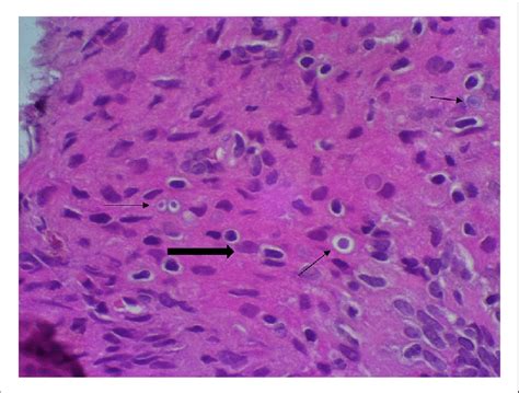Demonstrates Von Hansemann Cells Filled Thick Arrow And Download Scientific Diagram