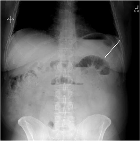 Ileus X Ray Gallstone Ileus The Lancet