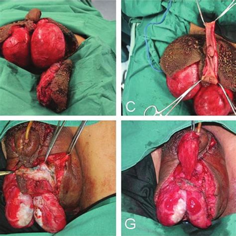 Clinical Photographs For Surgical Excision And Scrotal Reconstruction