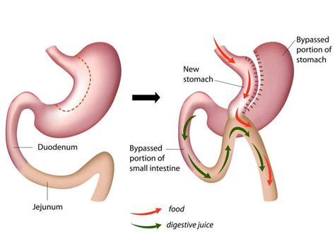 Laparoscopic Mini Gastric Bypass Dr Jenit Gandhi