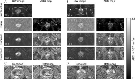 Accelerating Prostate Diffusion Weighted Mri Using A Guided Denoising Convolutional Neural
