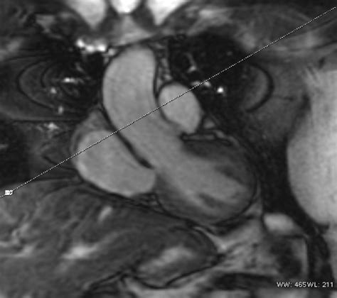 Aortic Regurgitation Cardiac Mri
