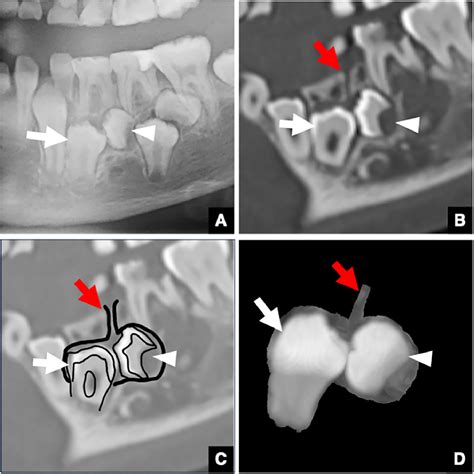 Imaging Characteristics Of Gubernaculum Tracts In Patients With
