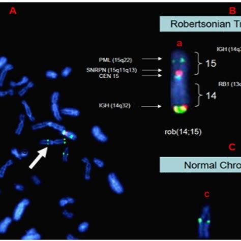 Fish Studies For Mds Bm Metaphase Spreads Were Hybridized With