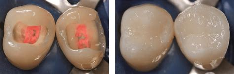 Direct Post Endodontic Restorations With A Tight Seal Dentsply Sirona Uk