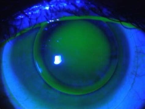 Importance Of Keratometry In Contact Lens Practice Optography