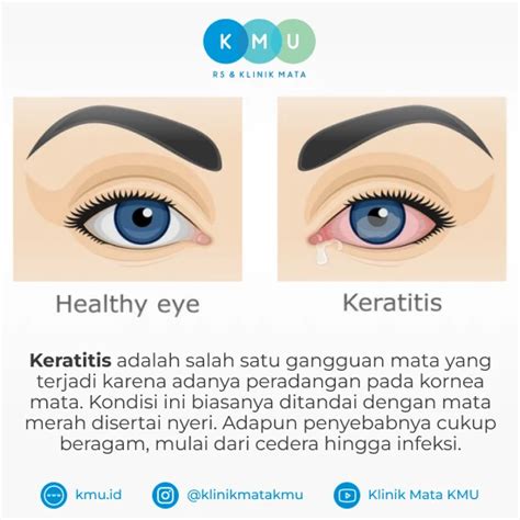 Apa Itu Keratitis Simak Gejala Penyebab Dan Pengobatannya