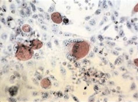 Chlamydia Trachomatis Giemsa Stain