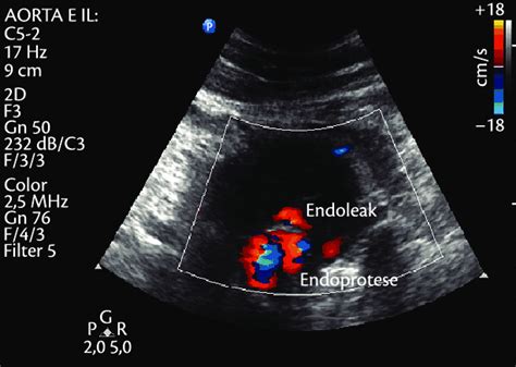 Vascular Doppler Ultrasound Showing Endoleak Prior To The Stent Download Scientific Diagram