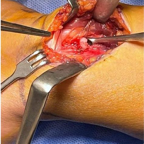 Dorsal Wrist Approch Of Distal Radioulnar Joint With Excisional Biopsy
