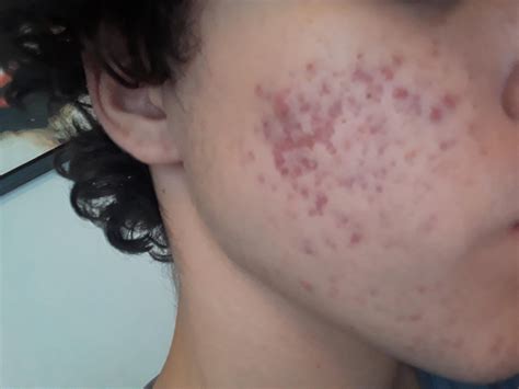 Is This Pie Scars Or Is It Still Active Acne Racne