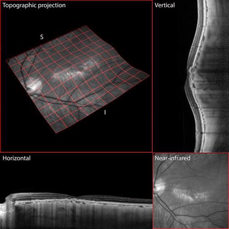 Type 1 Neovascularization With Polypoidal Lesions Complicating Dome