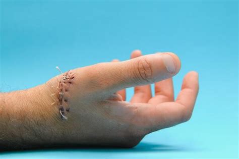 Medical Stitches Stock Photos Images And Backgrounds For Free Download