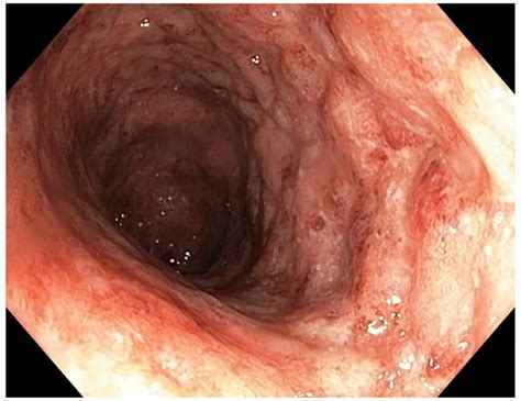 Pyoderma Gangrenosum In Ulcerative Colitis Patient Treated With Vedolizumab Adsorptive