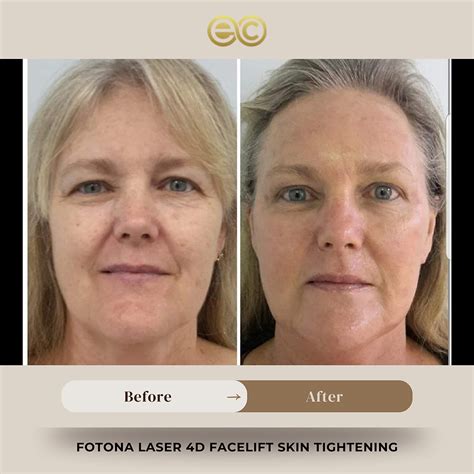 Fotona 4d Laser Facelift Non Surgical Skin Tightening And Rejuvenation