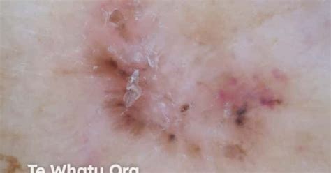 Superficial Basal Cell Carcinoma Dermoscopy Image Superficial Basal Cell Carcinoma Dermoscopy Image