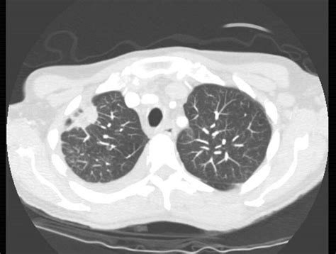 Computed Tomography Scan Showing Right Upper Lobe Speculated Anterior