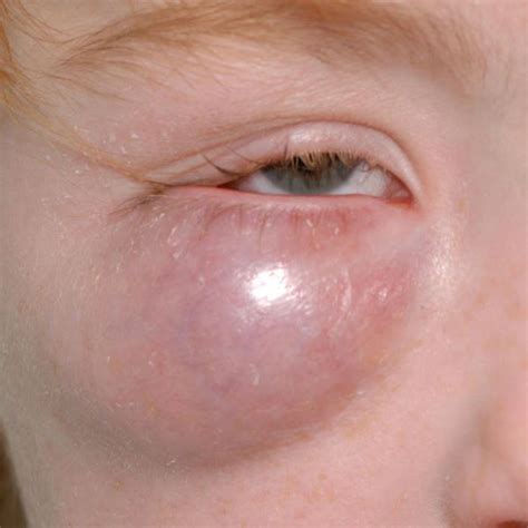 ऑर्बिटल सेल्युलाइटिस क्या है कारण लक्षण और इलाज Orbital Cellulitis In Hindi