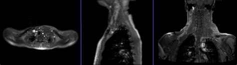 Mri Clavicle Protocols Planning Positioning And Indications