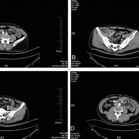 An Obstructed And Swollen Appendix As Seen During Colonoscopy