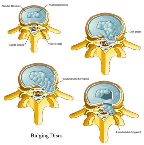 MYO Therapy Healthcare Institute When You Have A Bulging Disc How To Safely Practice Yoga