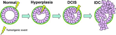 Stage 2 Dcis Stage 2 Breast Cancer Treatment Timeline Survival