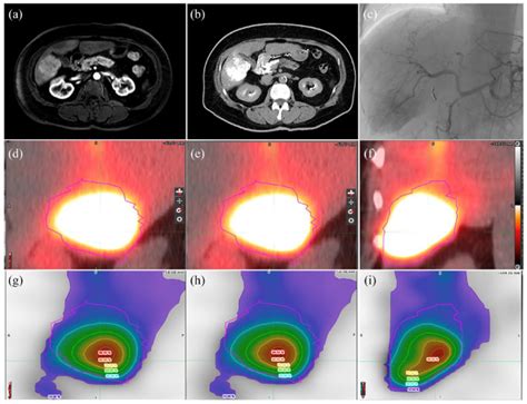 New Frontiers In Radioembolization Pmc