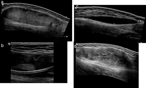 Morel Lavallée Lesion Diagnosis And Treatment With Imaging Techniques