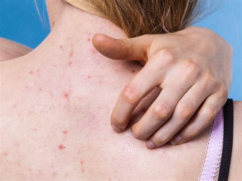Back Acne Treatment Did You Know Bacne Is A Real Thing Heres All