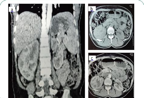 A B C 1 Year Follow Up Ct Scan Of 30 Year Old Diabetic After Medical