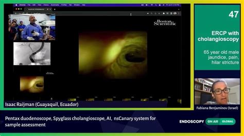 Endorx On Linkedin Ercp With Cholangioscopy Isaac Raijman
