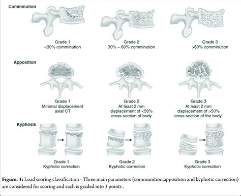 Thoracolumbar Fractures Classification And Clinical Relevance International Journal Of Spine Thoracolumbar Fractures Classification And Clinical Relevance International Journal Of Spine