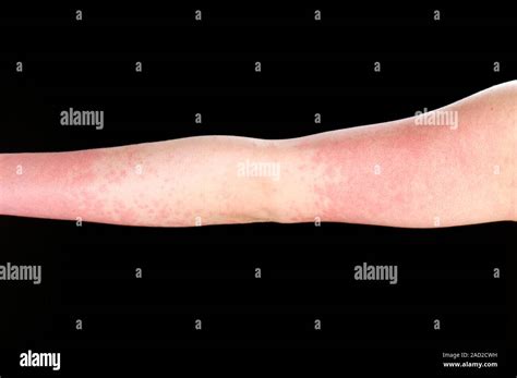 Epstein Barr Virus Infection Close Up Of The Arm Of A 19 Year Old Female Patient With A Rash