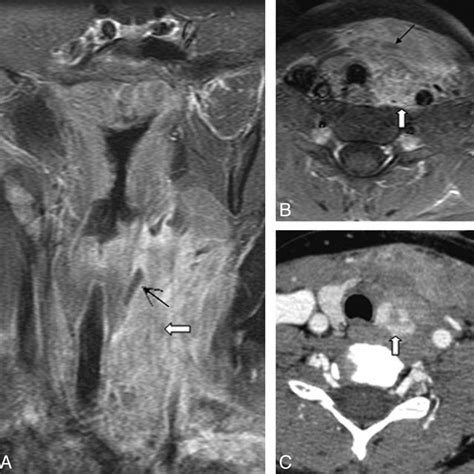 A Contrast Enhanced Axial Ct Scan At The Level Of The Thyroid Gland Download Scientific