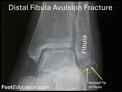 Avulsion Fractures In The Foot Telltale Radiographic Signs To Avoid